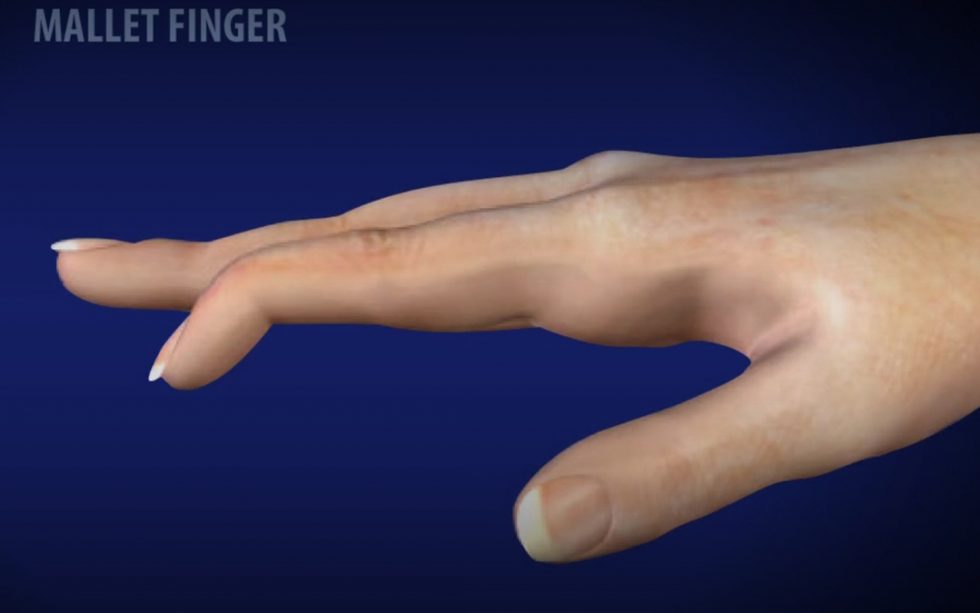 What Is A Mallet Finger? - Virtual Hand Care