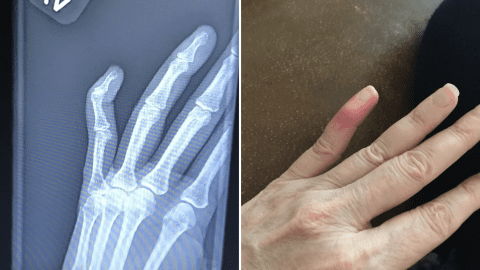 What is a Mallet Finger Injury? - Virtual Hand Care
