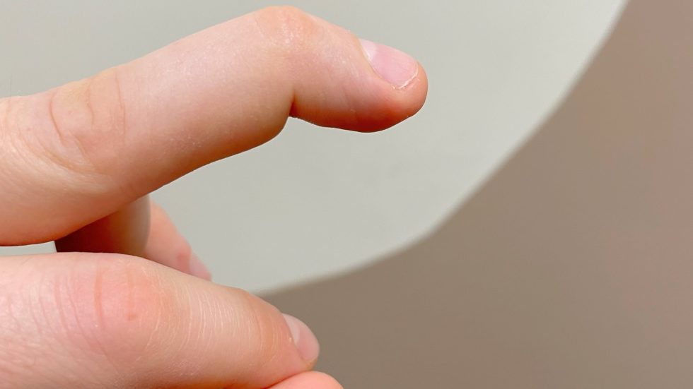 Mallet Finger Treatment - Virtual Hand Care